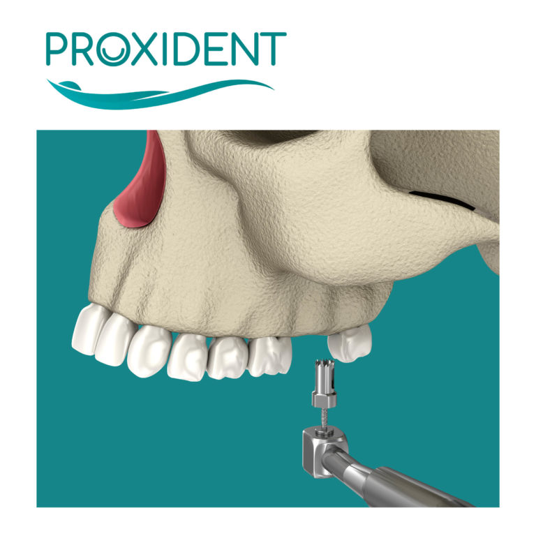 Sinus Lift pour la pose d’implant dentaire - Proxident